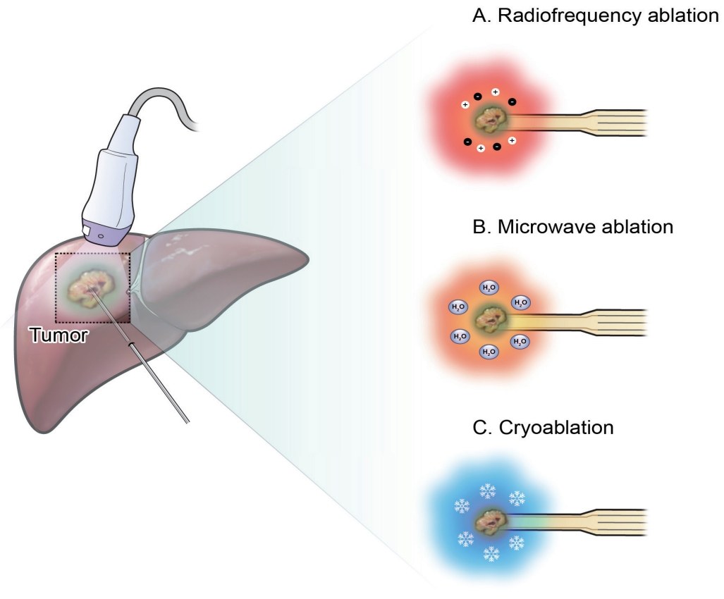 Microwave Ablation In Bangalore - Dr. Basavaraj Biradar